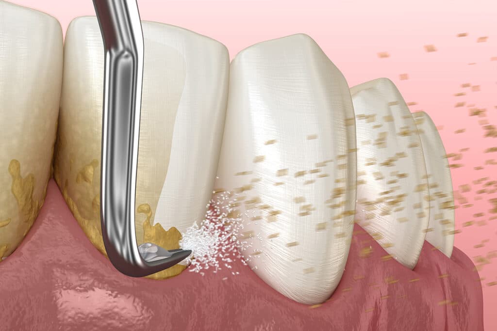 Scaling & Root Planing for Gum Disease | Periodontist in Harrisburg Area